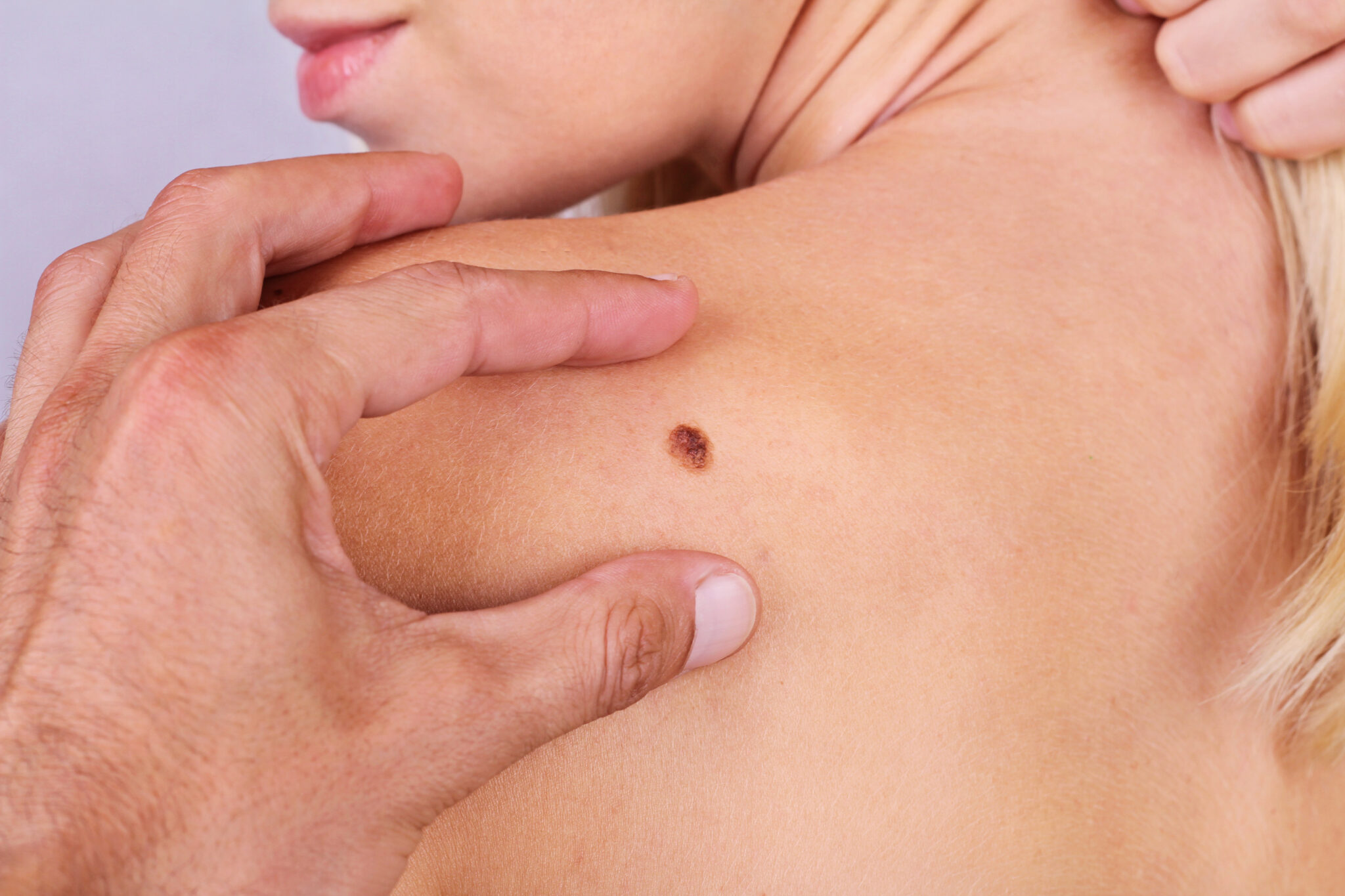 ABCDE's of Melanoma - Skin Cancer | Westchester Center for Dermatology